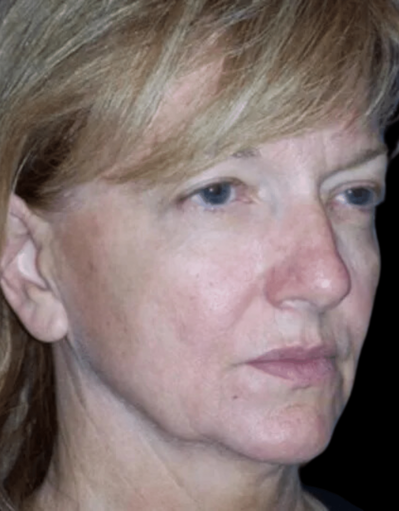 RESTORE - RE•LIFT™ Me