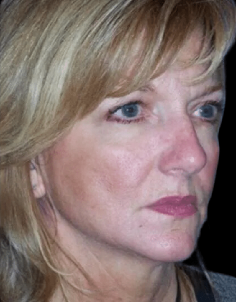 REFRESH - RE•LIFT™ Me