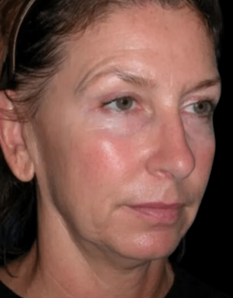 REFRESH - RE•LIFT™ Me