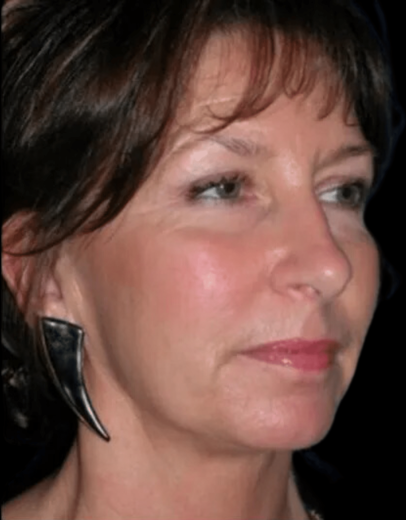 REFRESH - RE•LIFT™ Me